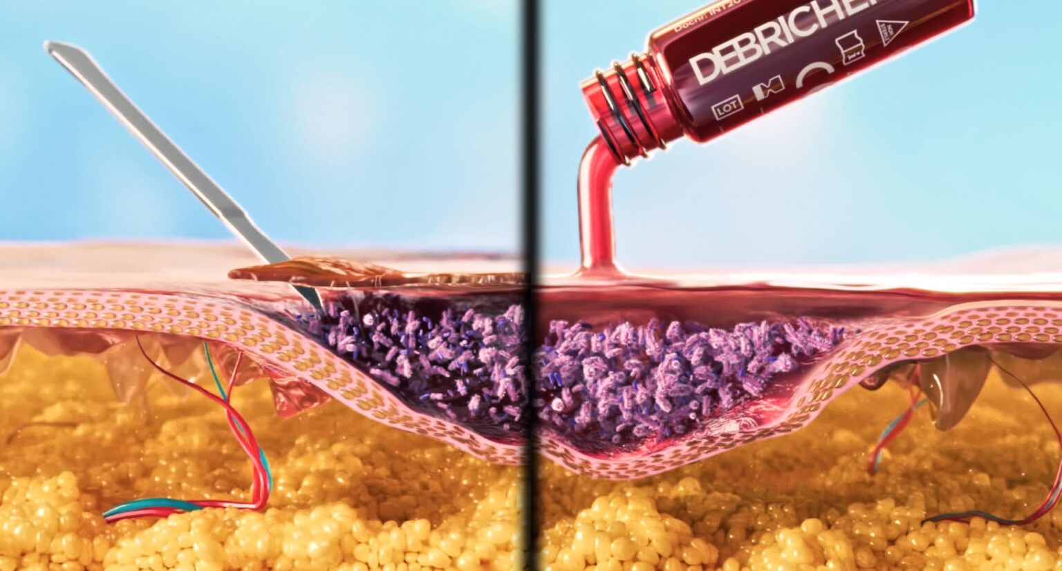 Clinical Trial on Chemical Debridement Addressing the Challenge of ...