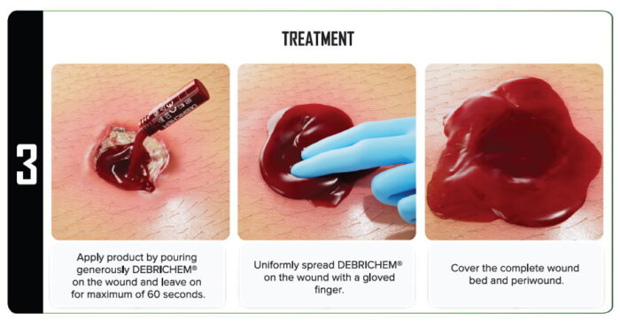 DEBRICHEM® INNOVATING THE FUTURE OF WOUND CARE - Innovating The Future ...