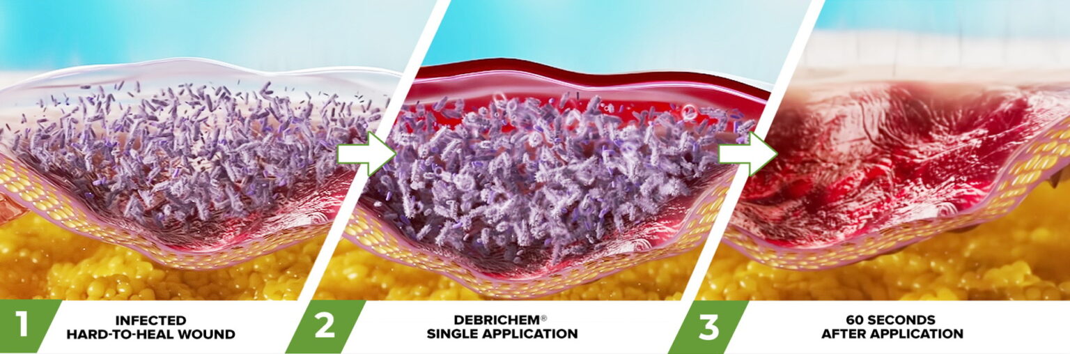 DEBRICHEM® INNOVATING THE FUTURE OF WOUND CARE - Innovating The Future ...