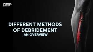 Different Methods of Debridement: An Overview - Innovating The Future ...
